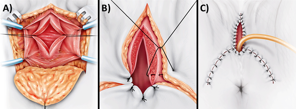 Healthy Female Urethral Opening